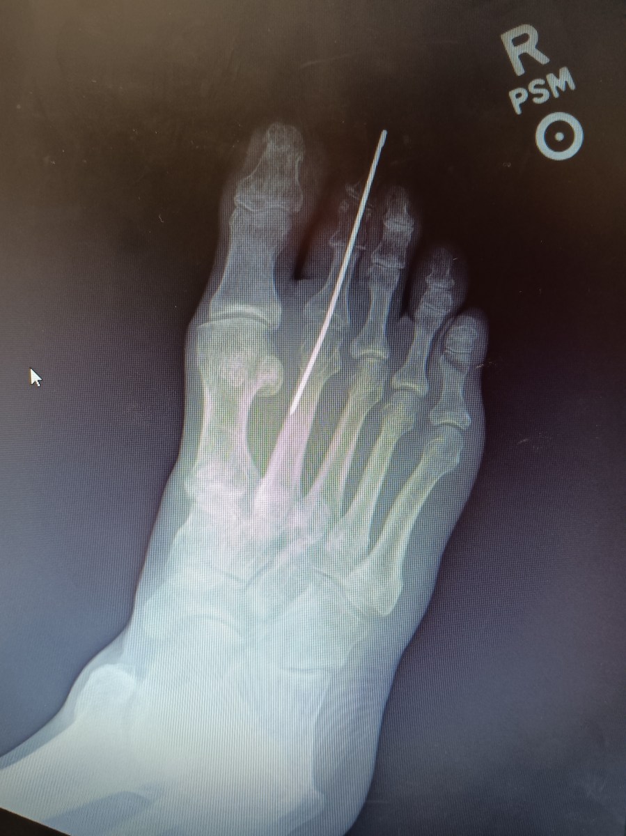 Hammer-toe Time Again: Surgery and Convalescence Six Weeks In ...